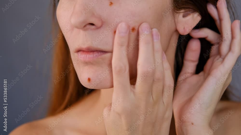 Woman with burns on her face after removing moles cosmetic aesthetic ...