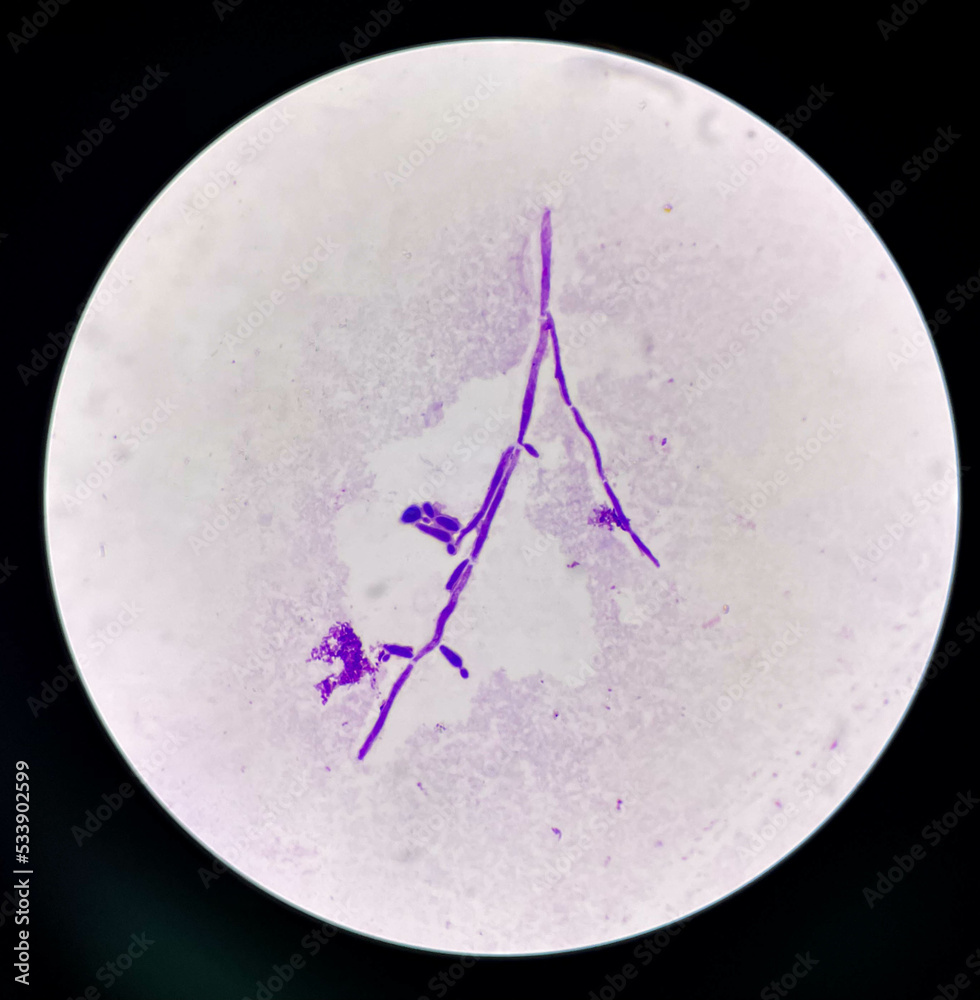 Budding yeast cells with pseudohyphae in urine sample on wright gimsa ...