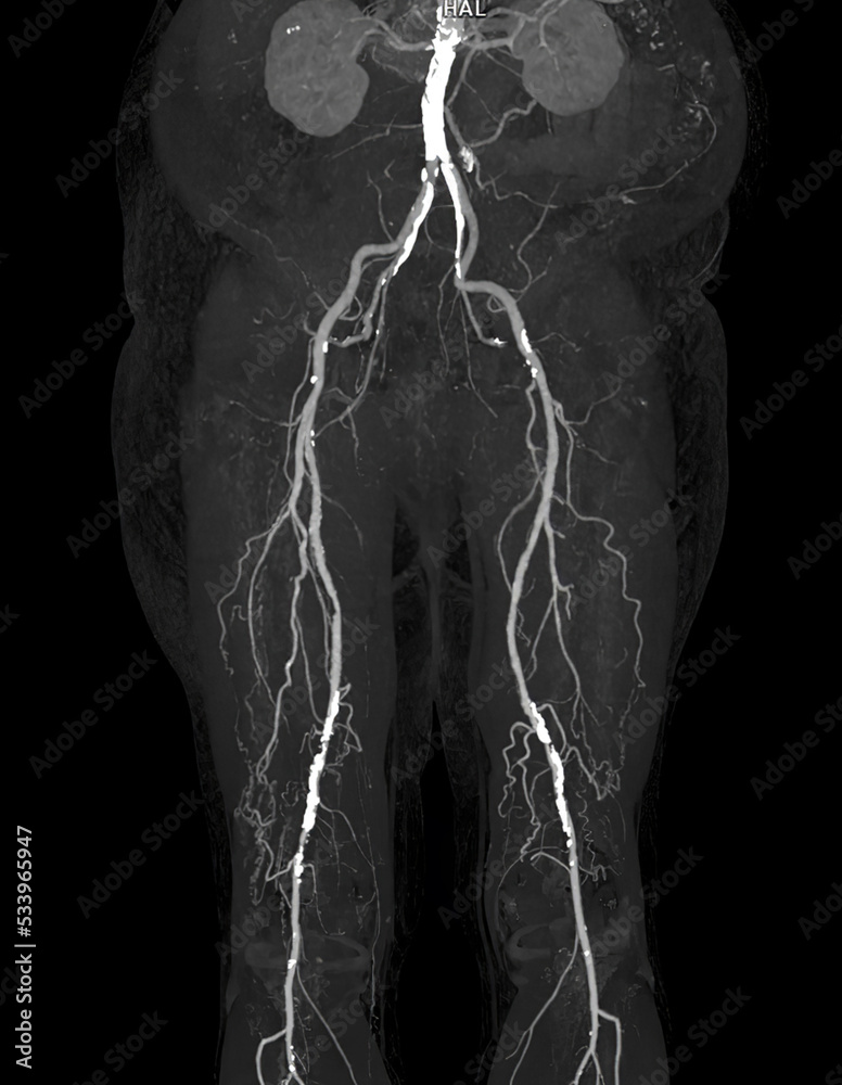 CTA femoral artery run off . Stock Illustration | Adobe Stock