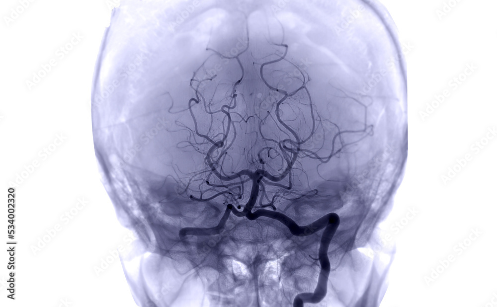 Cerebral angiography image . Stock Illustration | Adobe Stock