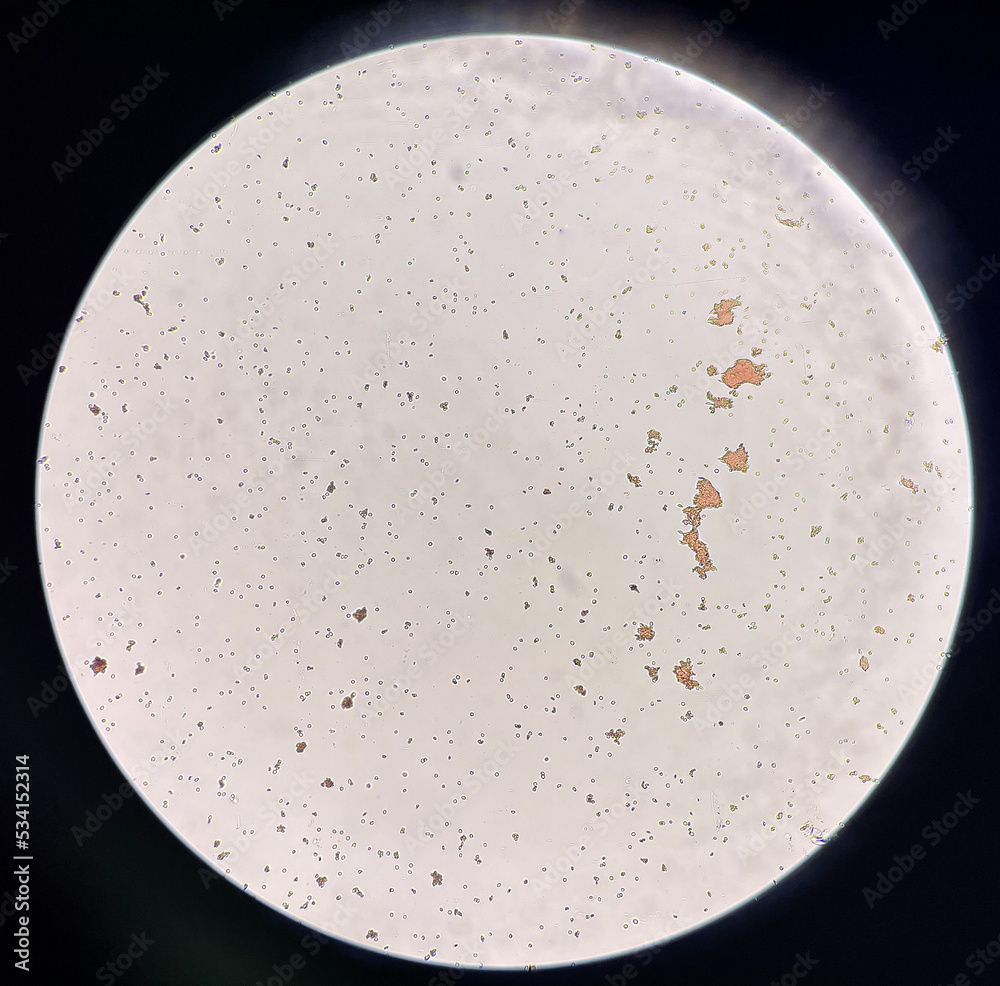 Red blood cell agglutination Crossmatching Incompatible donor. Stock ...
