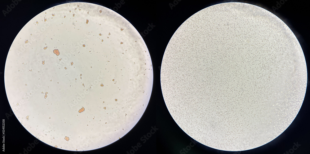 Left Red blood cell agglutination Crossmatching Incompatible donor ...
