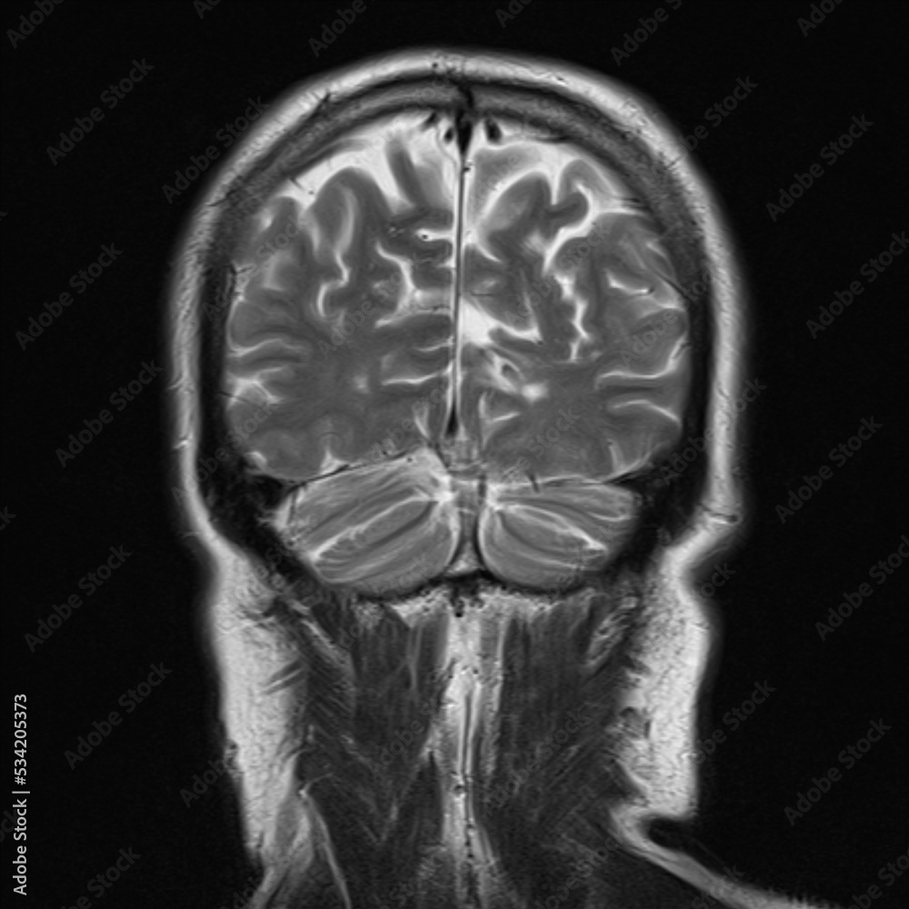 normal T1 coronal plane brain Magnetic resonance imaging (MRI) Stock ...
