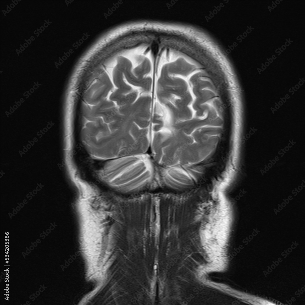 normal T1 coronal plane brain Magnetic resonance imaging (MRI) Stock Photo | Adobe Stock