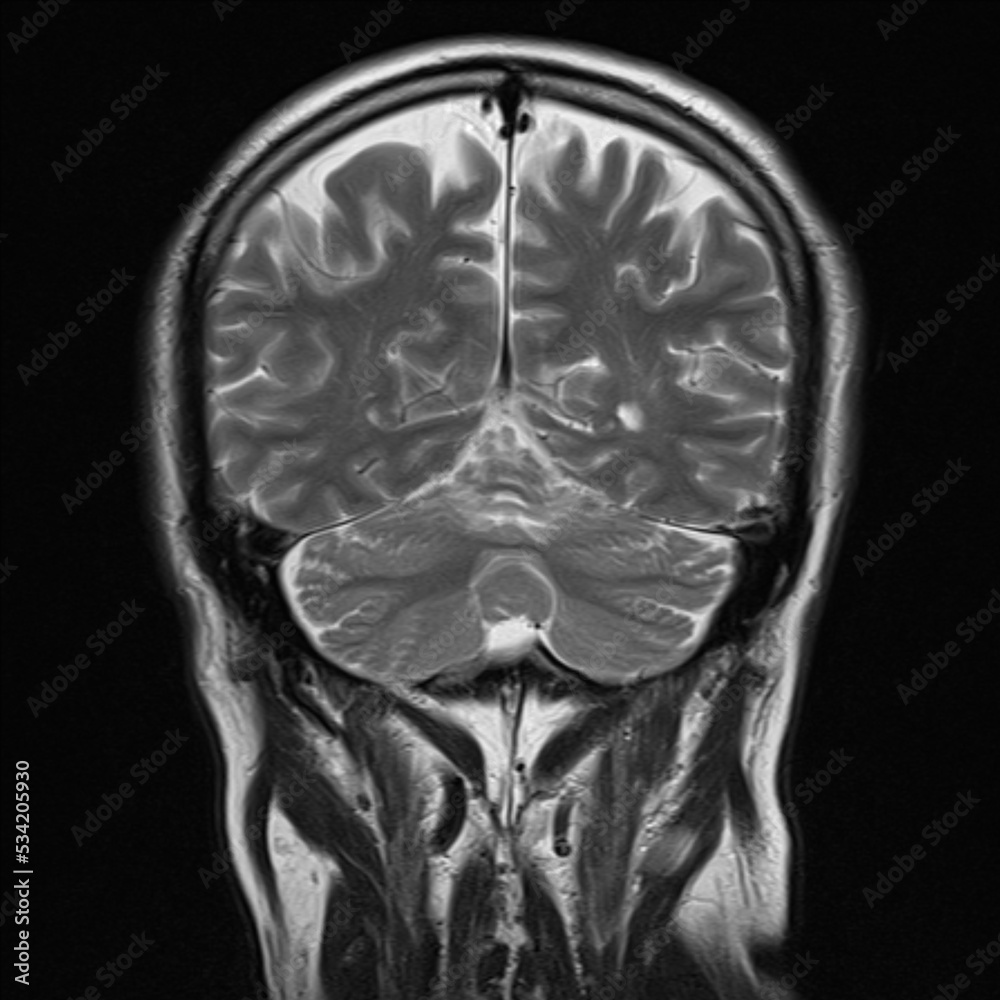 Transverse Plane Brain