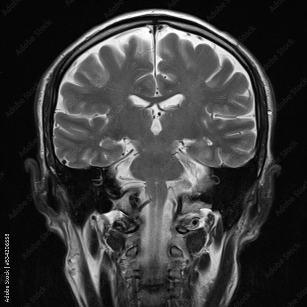 normal T1 coronal plane brain Magnetic resonance imaging (MRI) Stock Photo | Adobe Stock