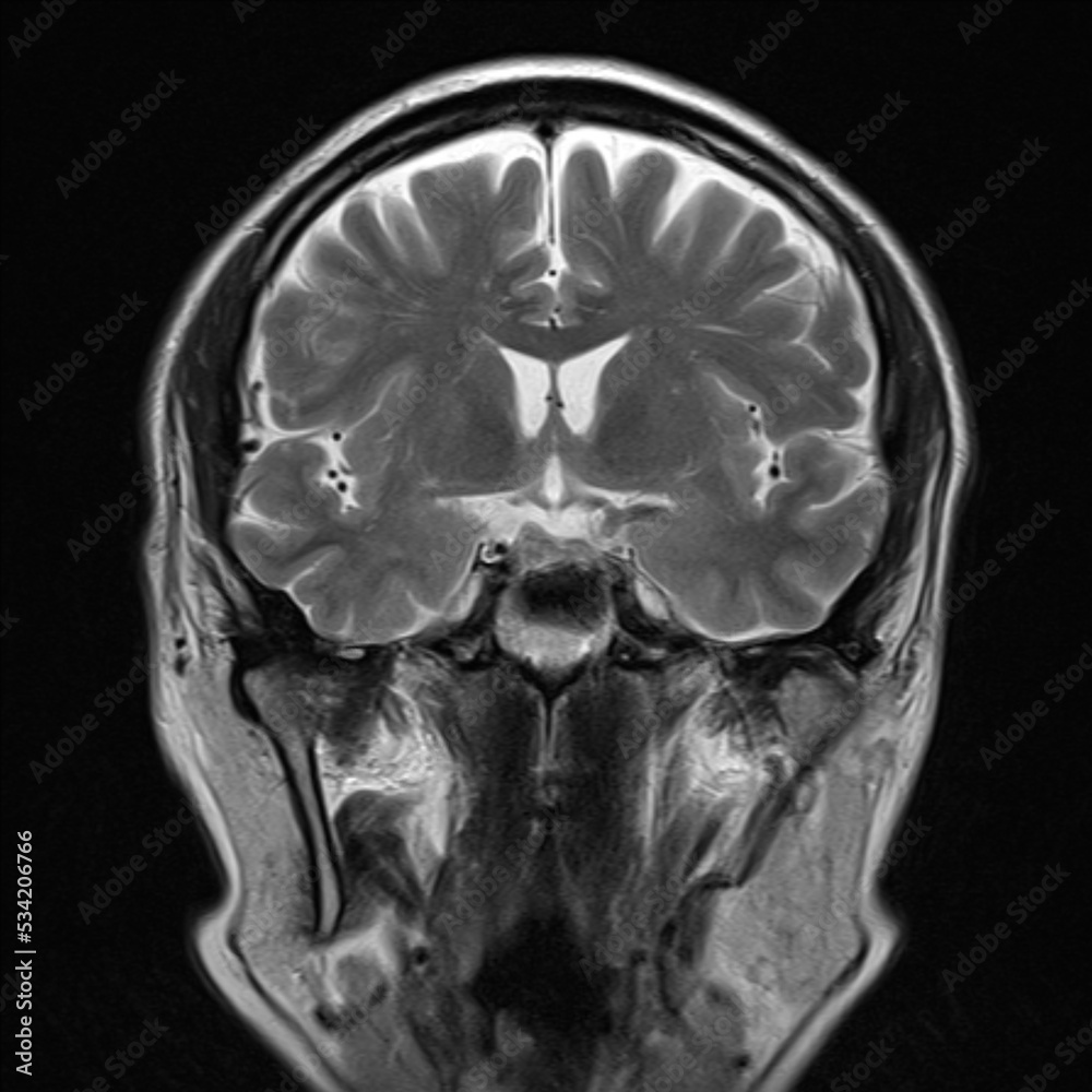 normal T1 coronal plane brain Magnetic resonance imaging (MRI) Stock ...