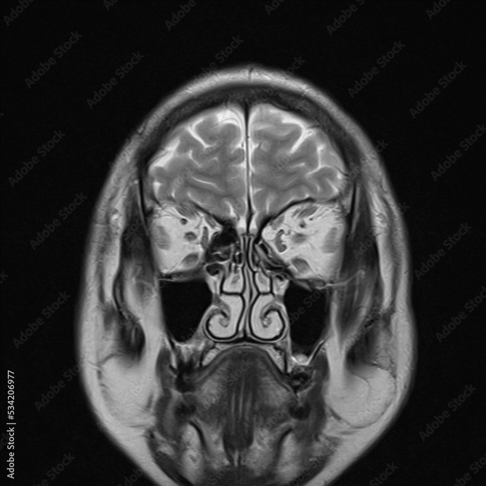normal T1 coronal plane brain Magnetic resonance imaging (MRI) Stock ...