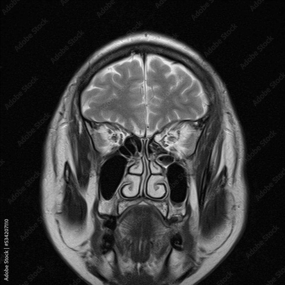 normal T1 coronal plane brain Magnetic resonance imaging (MRI) Stock Photo | Adobe Stock