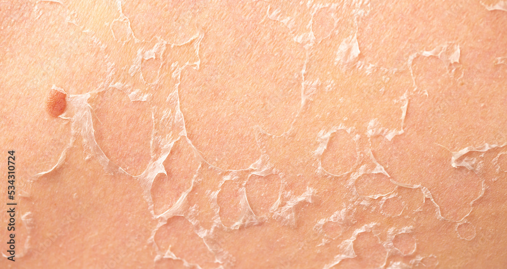Sunburn, close-up of human skin. Flaky skin from allergies, peeling or ...