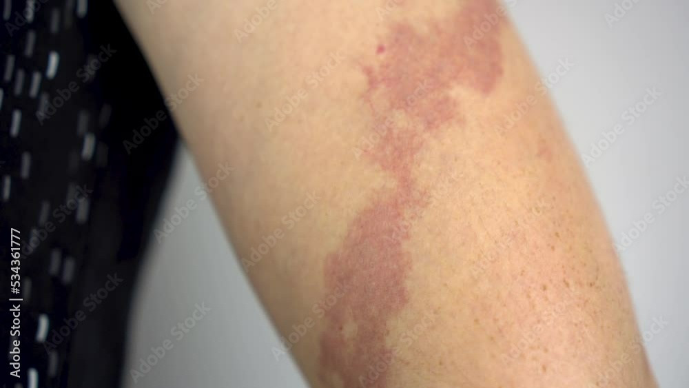 Large birthmark on the arm close-up. The capillaries are close to the ...