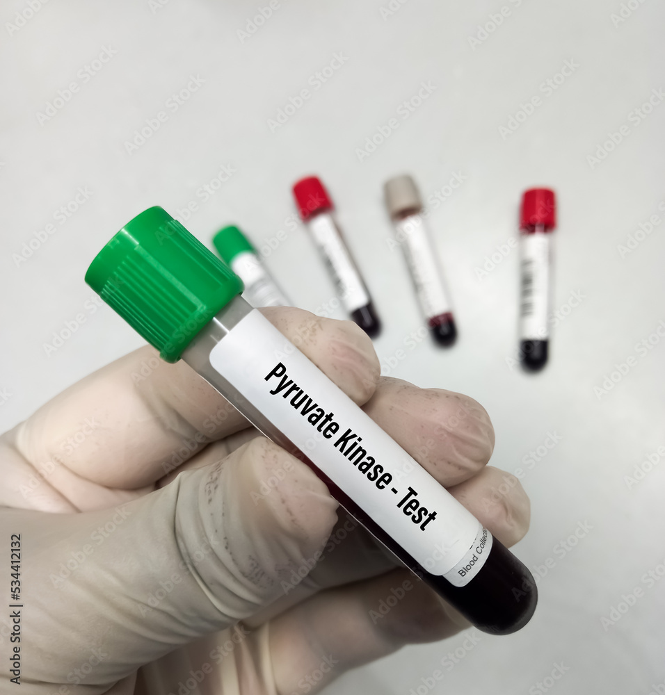Blood samples for Pyruvate Kinase test for pyruvate kinase deficiency ...