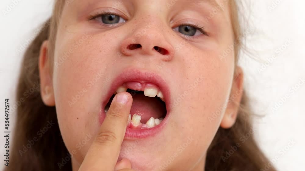 Little blond girl with blue eyes touching and showing milk tooth in ...