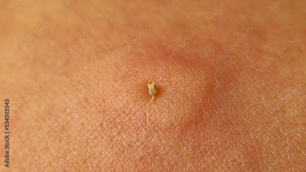 Bee's venom sac. Honey bee stings a man's arm. When the sting is over ...