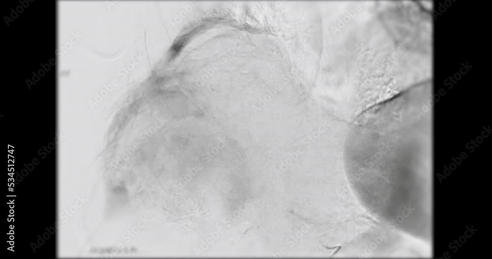 Angiogram balloon dialysis catheter inflated at Arteriovenous (AV ...