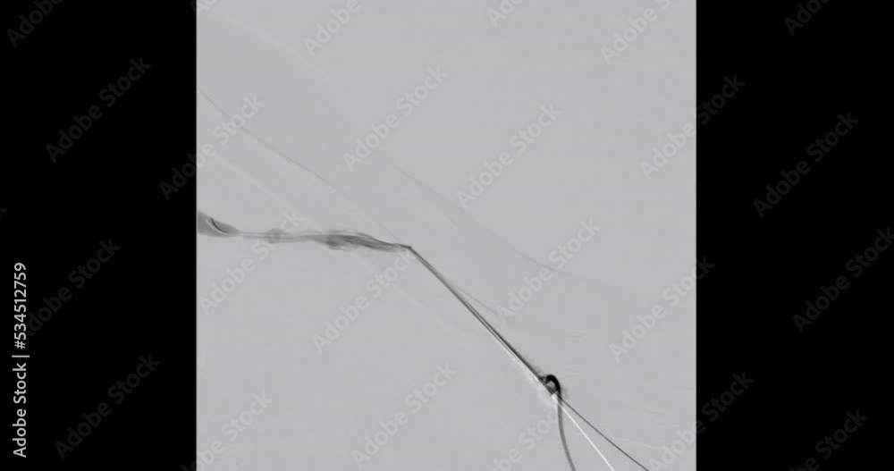 Angiogram balloon dialysis catheter inflated at Arteriovenous (AV ...