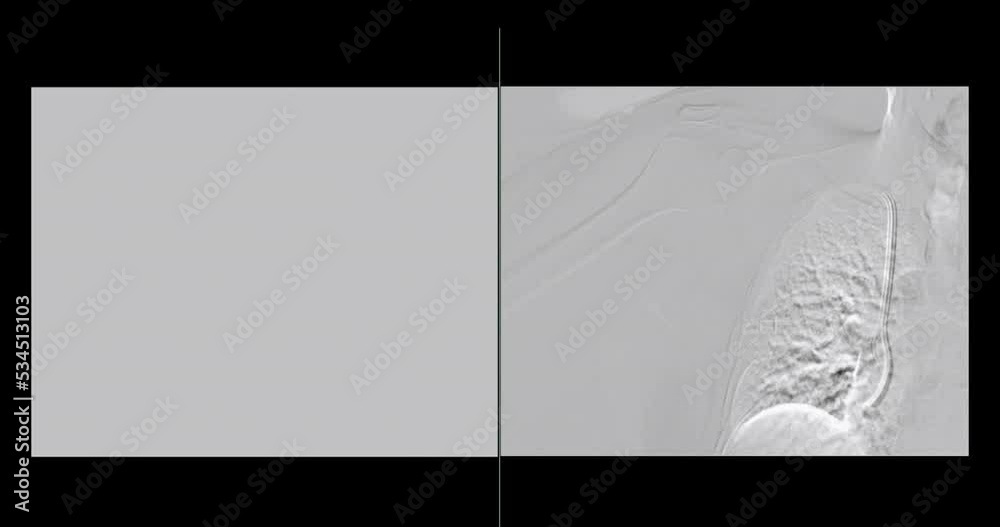 Angiogram balloon dialysis catheter inflated at Arteriovenous (AV ...