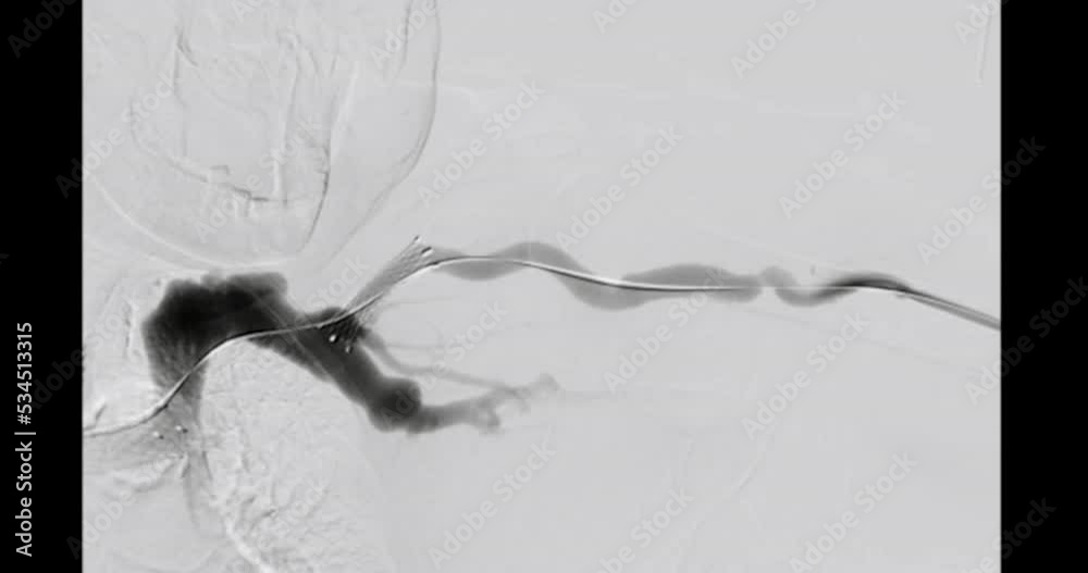 Angiogram balloon dialysis catheter inflated at Arteriovenous (AV ...