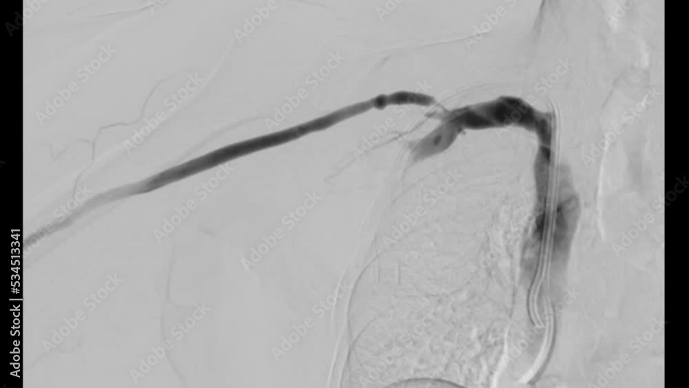 Angiogram balloon dialysis catheter inflated at Arteriovenous (AV ...