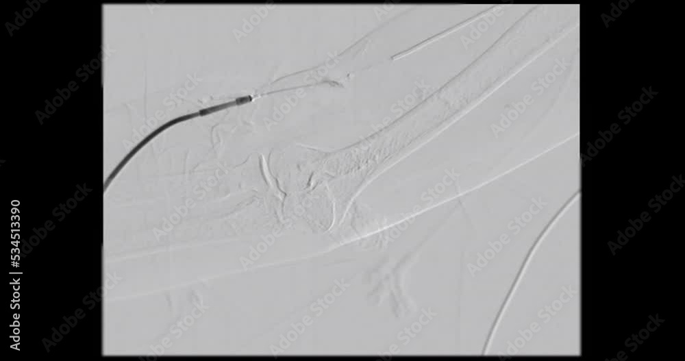 Angiogram balloon dialysis catheter inflated at Arteriovenous (AV ...