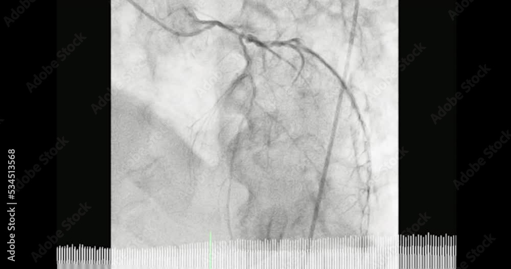 Cardiac catheterization showing coronary arteries for diagnosis cardiac ...