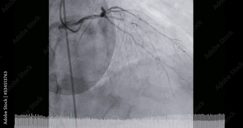 Cardiac catheterization showing coronary arteries for diagnosis cardiac ...