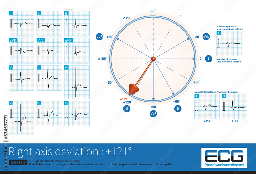 Ilustrace „When the electrical axis deviates to the right, the maximum ...