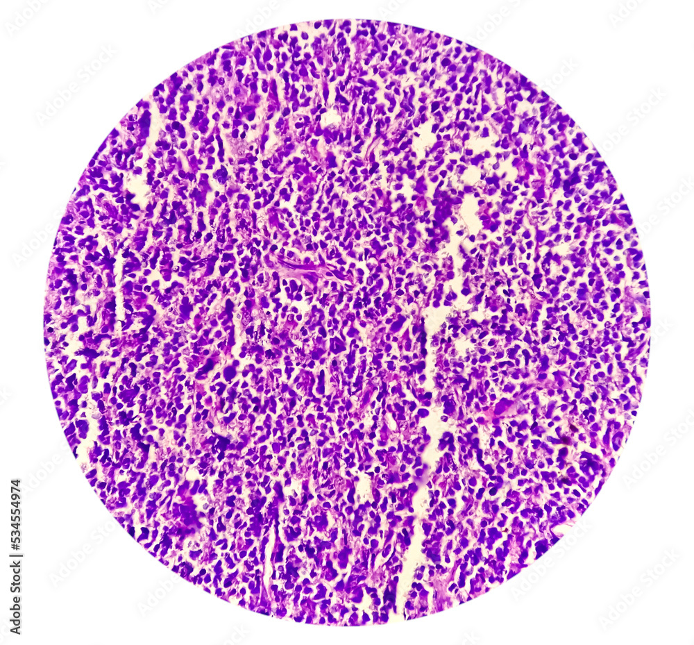 Cervical lymph node cytology: Lymphoproliferative disorder favor Non ...