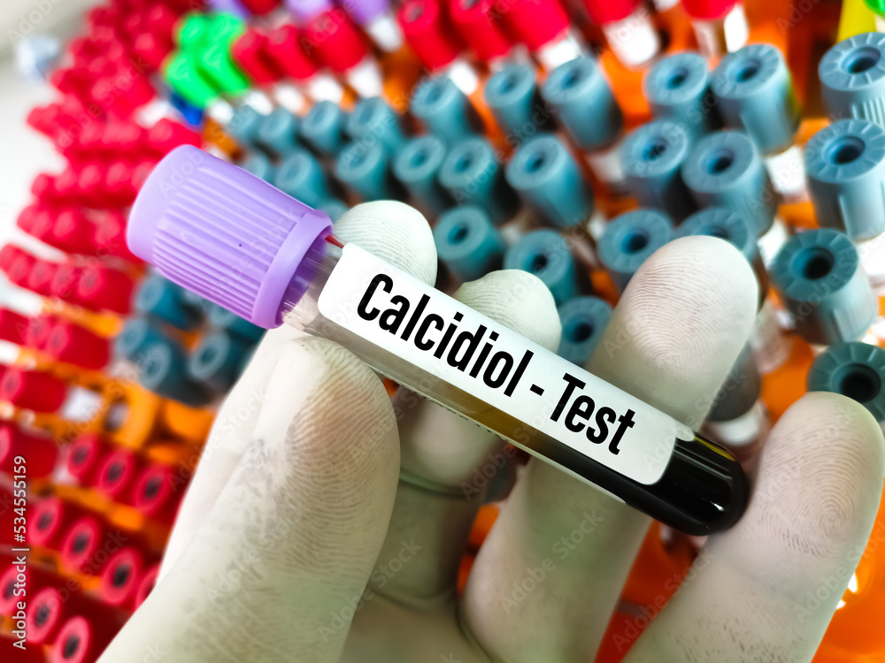 Blood sample for Calcidiol blood test, also known as the 25-OH vitamin ...