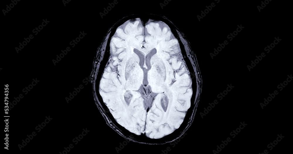 MRI of the brain in axil swi showing anatomy of the brain. vídeo de ...