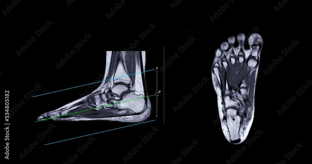 MRI foot scan for a diagnostic tool used to image the structures of the ...