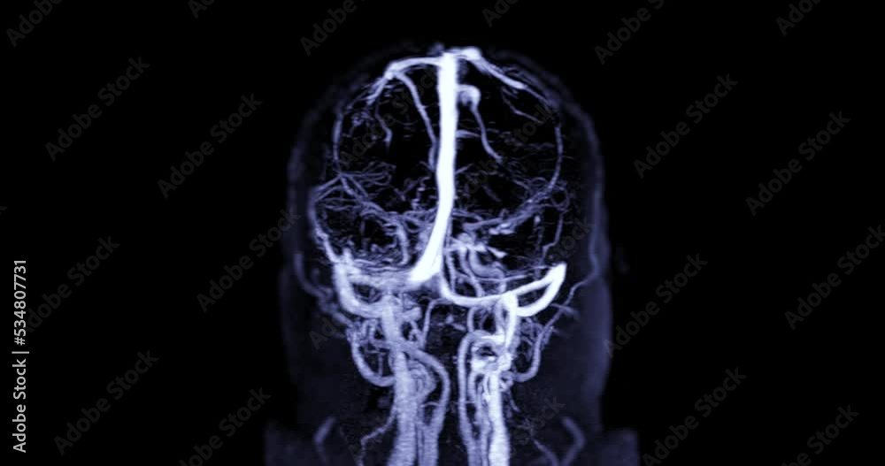 MR cerebral venography (MRV) is an MRI examination of the head with ...