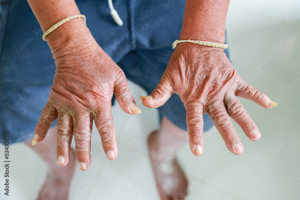 Skin disorder, pepper appearance from scleroderma, autoimmune disease ...