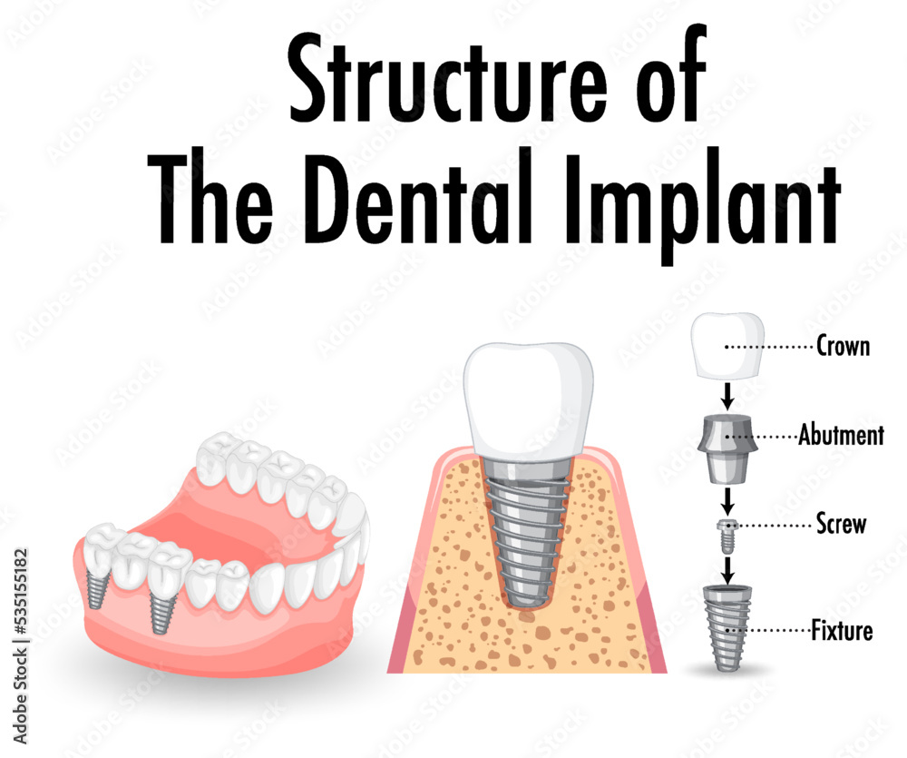 Infographic of human in structure of the dental implant Stock Vector ...