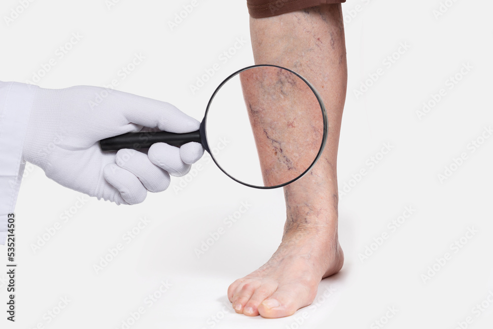 Doctor's hand in a white glove shows zoomed blood vessels with a ...