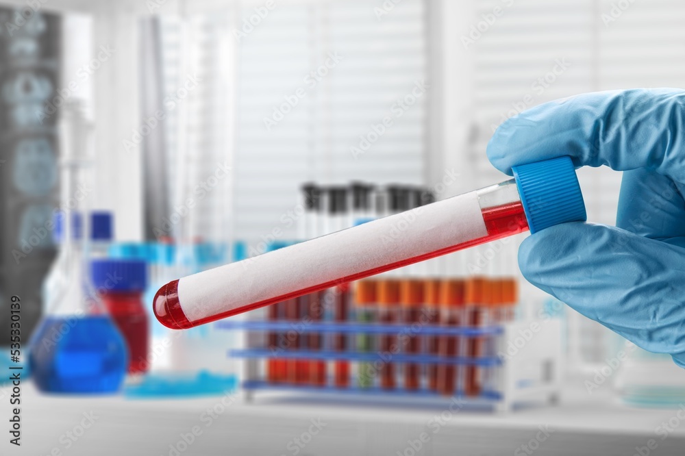 Blood sample tube for virus test. It is also known as the Moneypox ...
