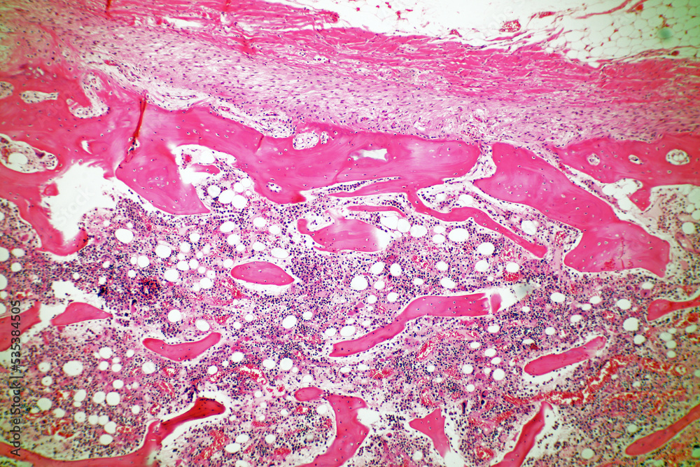 Microscope of Adenoid cystic carcinoma, rare type of cancer exist in ...