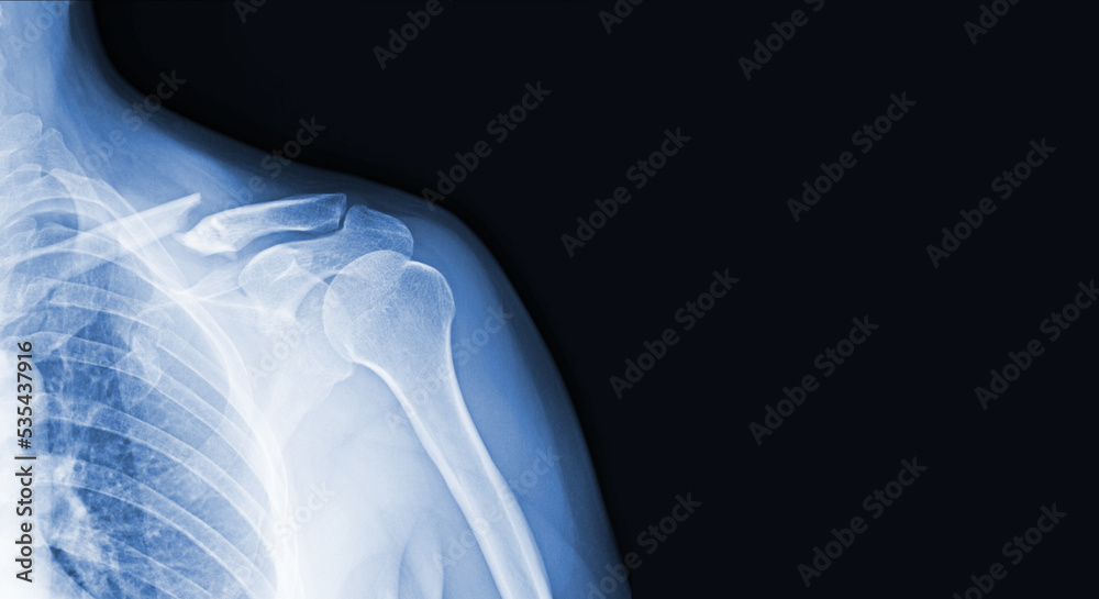 x-ray images of the shoulder joint to see injuries clavicle fracture ...