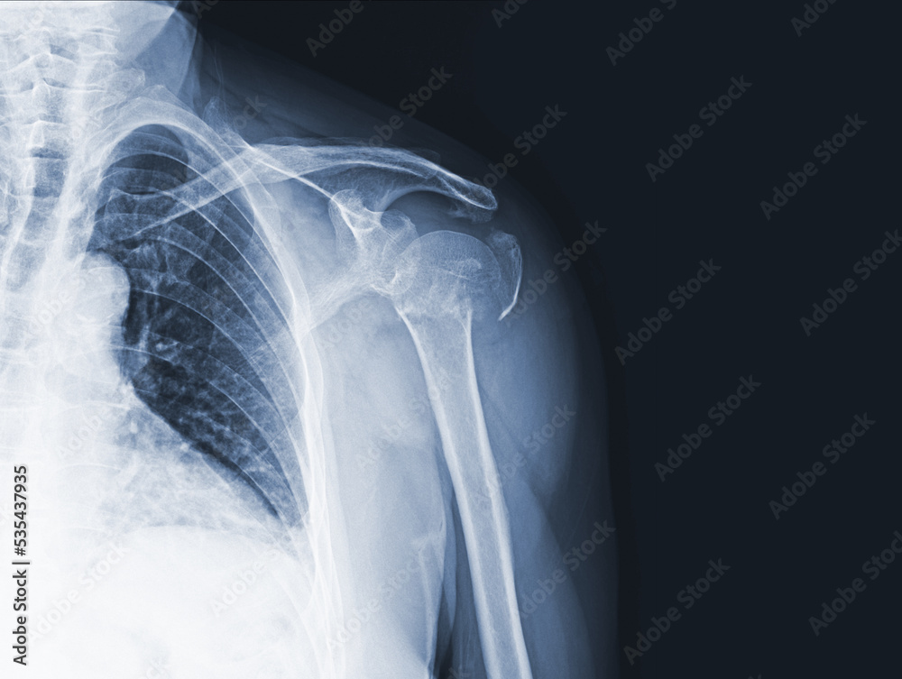 x-ray images of the shoulder joint to see injuries greater tubercle ...