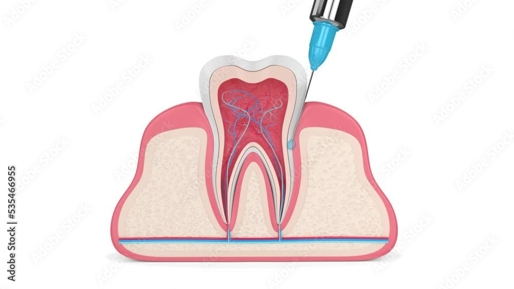 Tooth in gums with intraligamentary anesthesia procedure Stock-Video ...