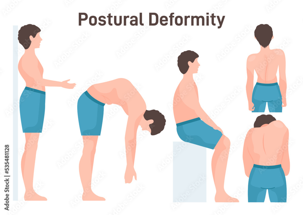 Stockvector Postural Deformity Scoliosis Curvature Illness Of Spine