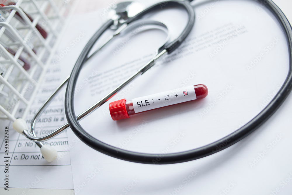 Laboratory: Blood sample positive with systemic lupus erythematosus SLE ...