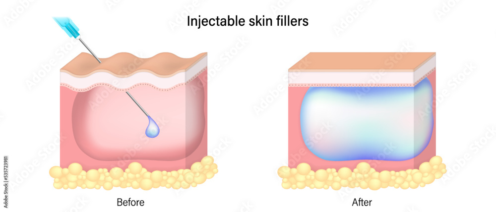 Injectable skin fillers. Dermal fillers. Skin before and after ...