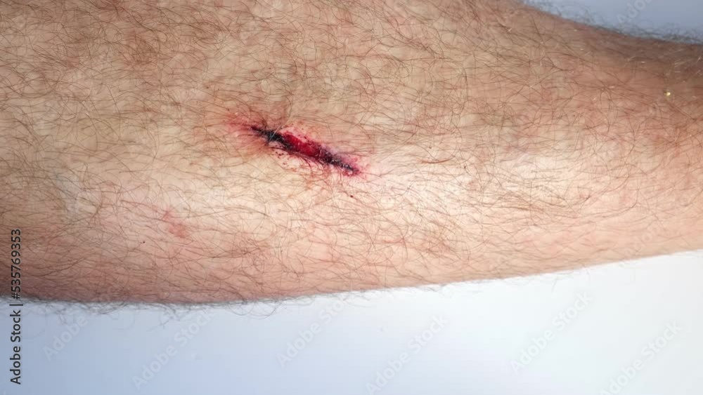 The Wound on a Leg of Young Man. Close Up. Open Red Wound, flows blood ...