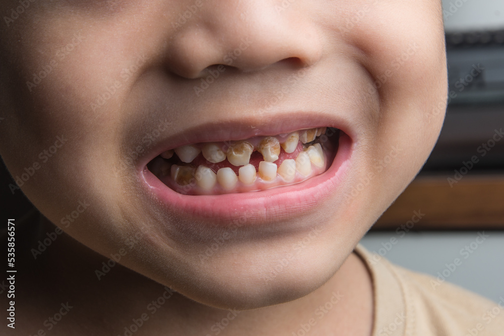 Untreated child's front teeth with plaque and caries, unhealthy baby teeth, Stock Photo | Adobe ...
