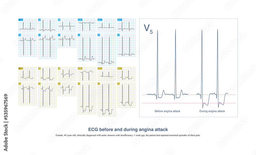 During the attack of angina pectoris, the degree of ST segment ...