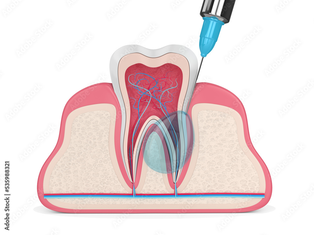 3d render of tooth in gums with intraligamentary anesthesia procedure ...