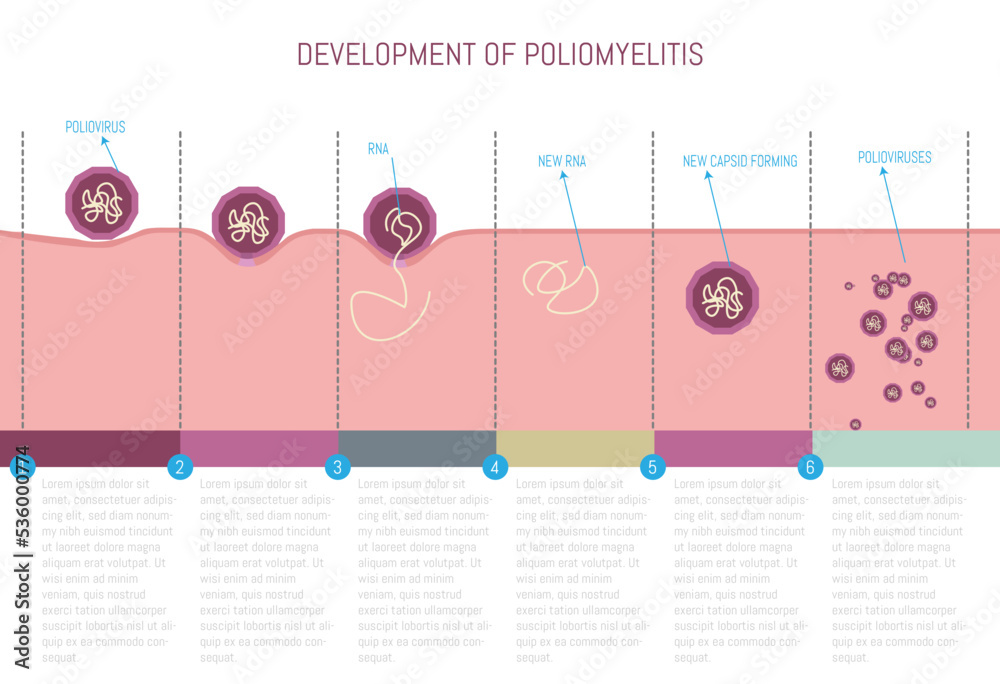 Infographic on polio disease, polio reproduction process. Celebration ...