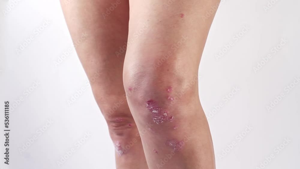Psoriatic arthritis with skin psoriasis on a woman's knees ...