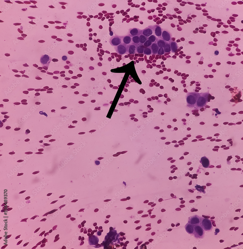 Axillary lymph node(FNA Cytology): Positive malignant cell, Metastatic ...